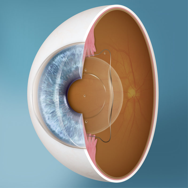 Vision Correction Surgery in Creve Coeur | SureVision Eye Centers
